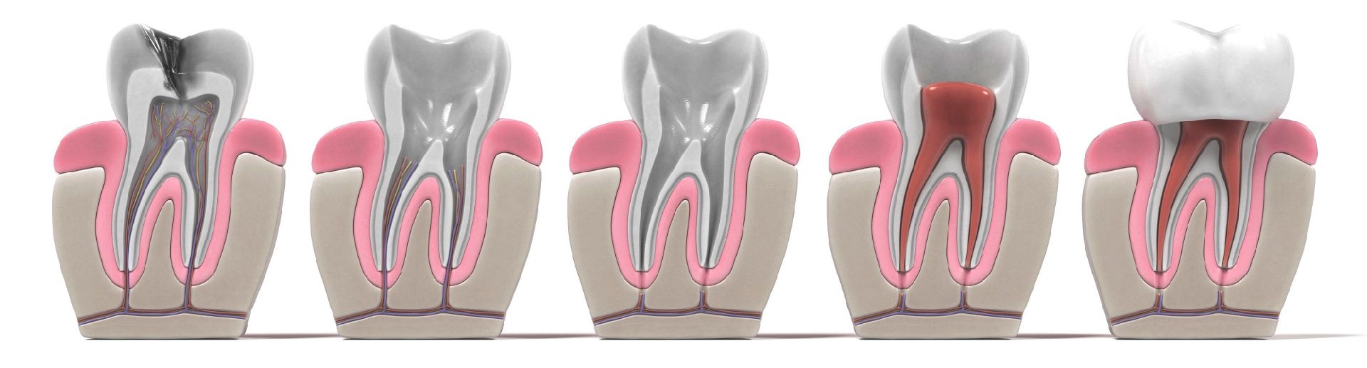 TRAITEMENT CANALAIRE - Lecorail